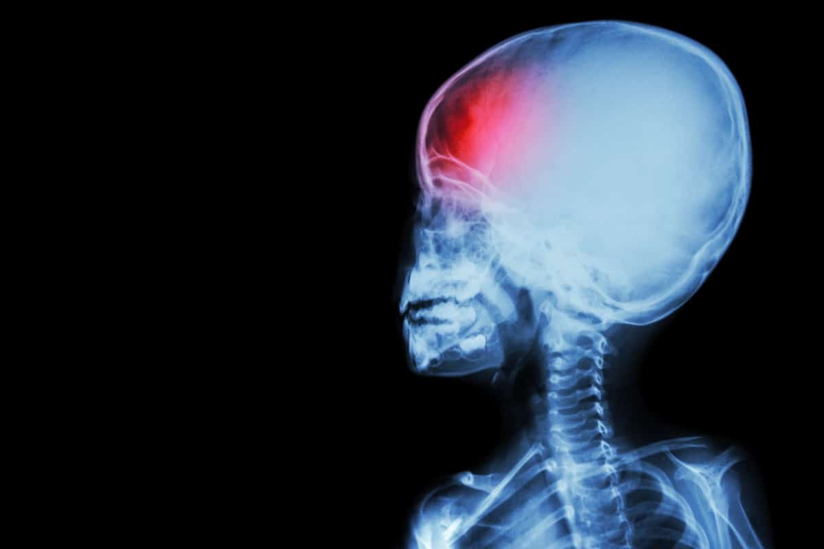 Study Shows Children with TBI At Risk to Develop Endocrine Disorders
